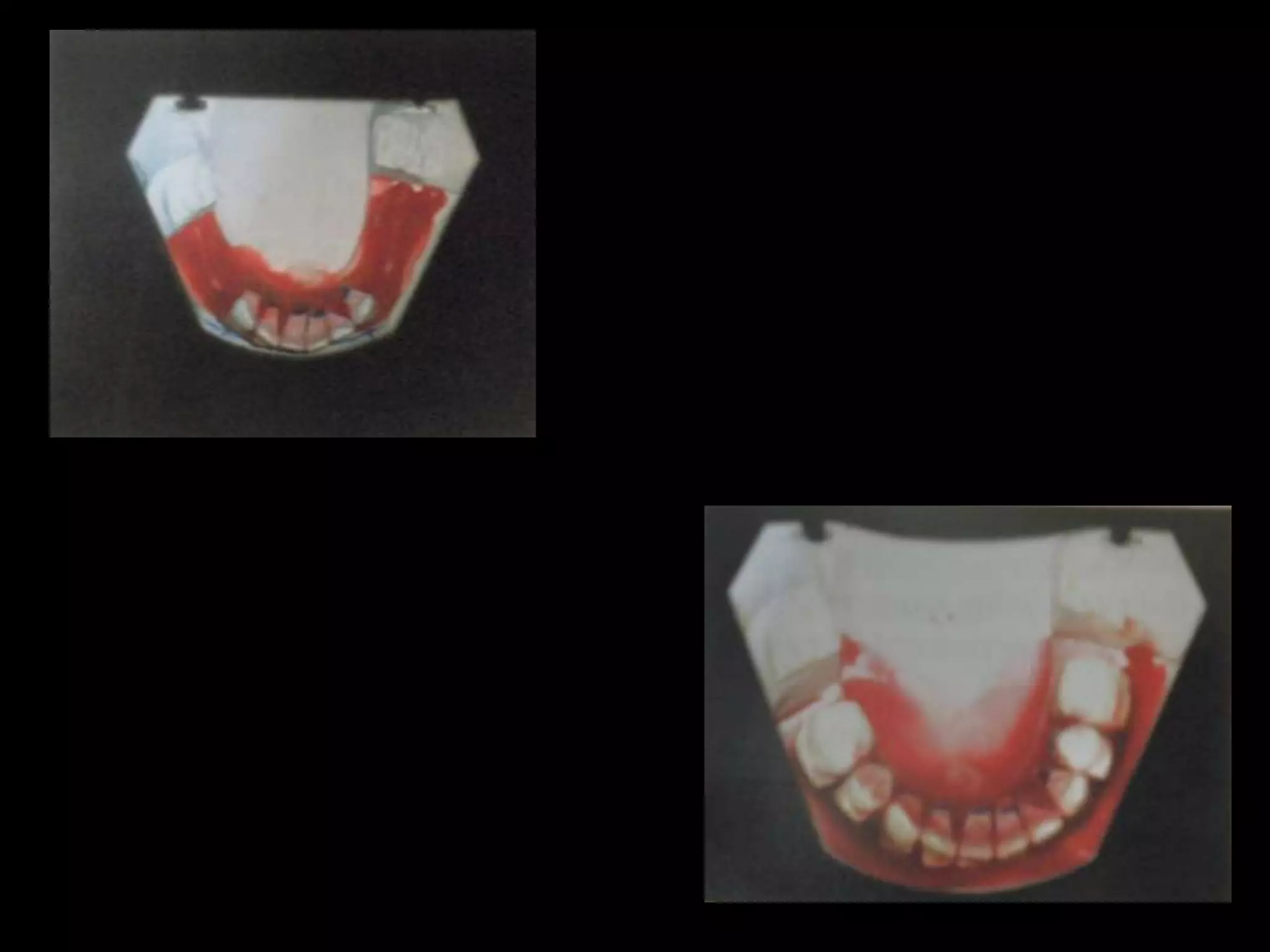 Kesling dagnostic setup | PPTX