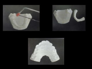 Kesling dagnostic setup | PPTX