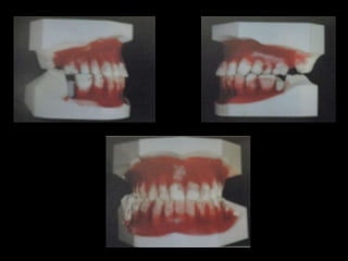 Kesling dagnostic setup | PPTX