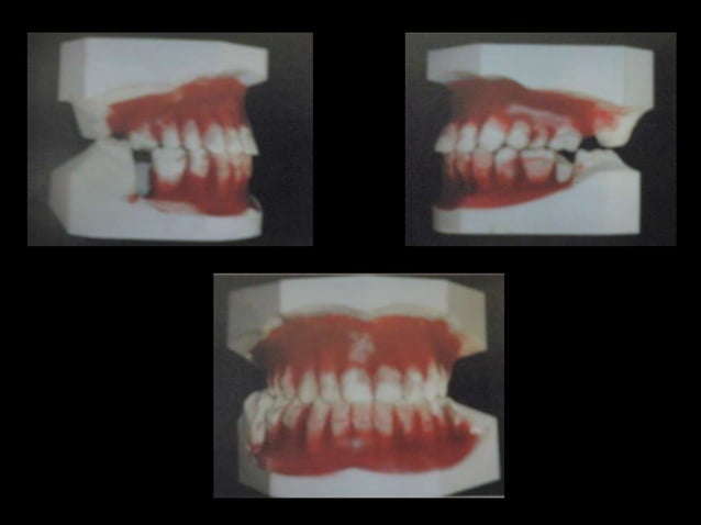 Kesling dagnostic setup | PPTX | Dental Health | Diseases and Conditions