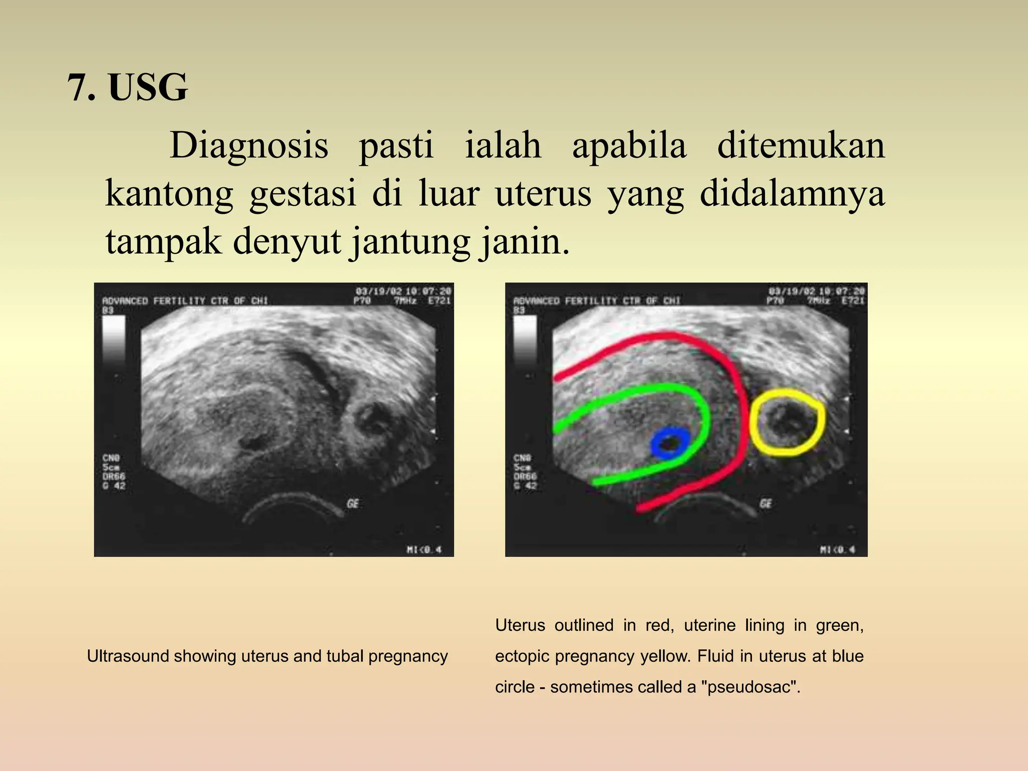 Materi - Kehamilan Ektopik Terganggu.pptx