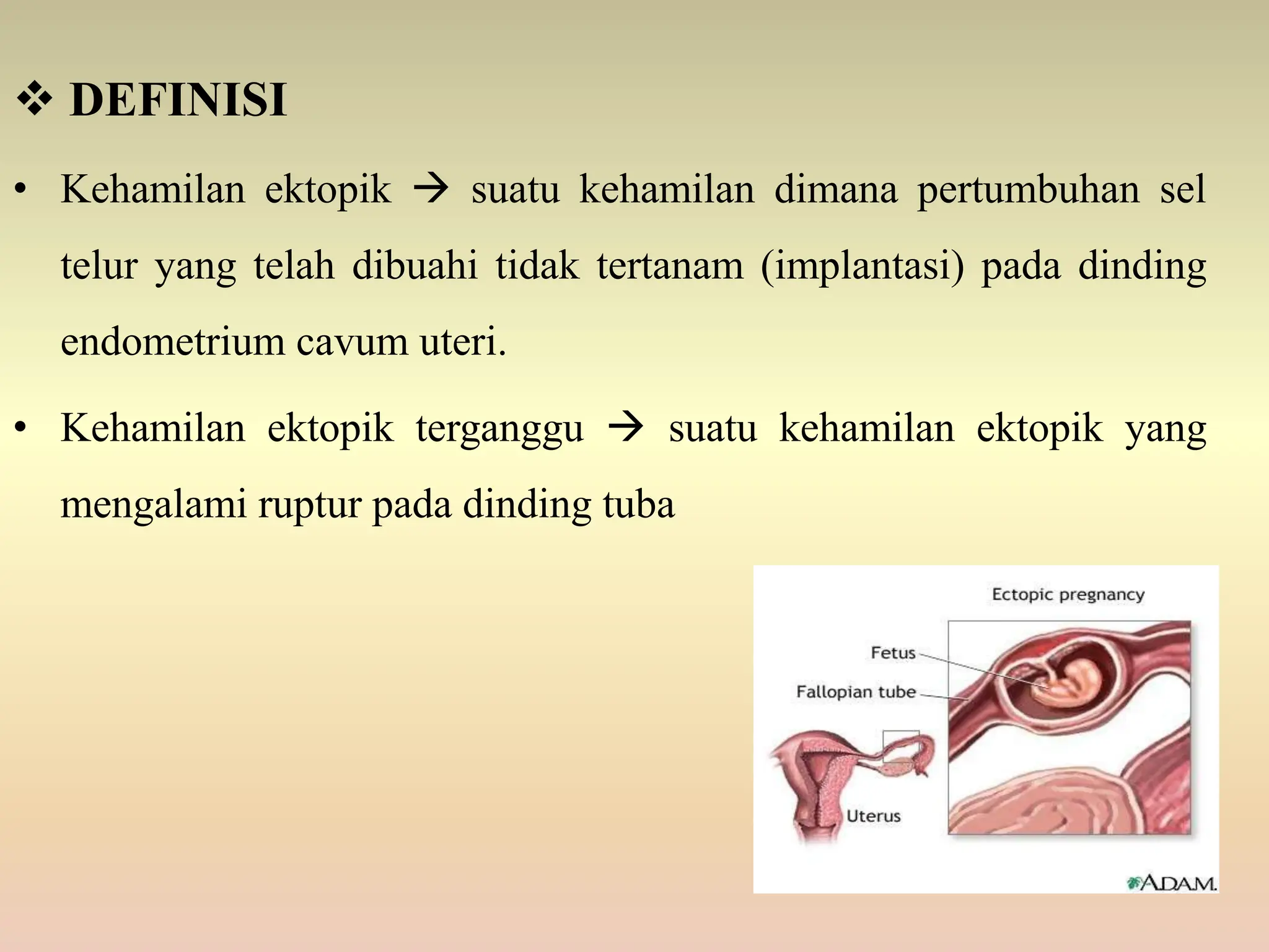 Materi - Kehamilan Ektopik Terganggu.pptx