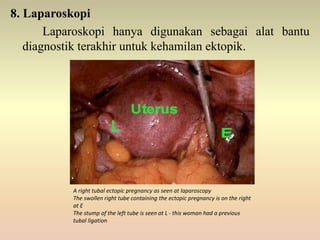 Materi - Kehamilan Ektopik Terganggu.pptx