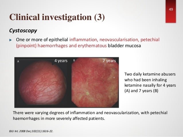 KETAMINE INDUCED CYSTOPATHY