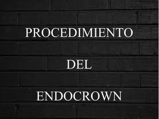 Endocrown_caso clinico | PPT