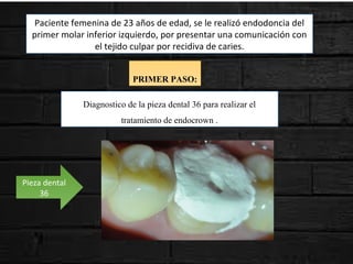 Endocrown_caso clinico | PPT