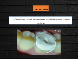 Endocrown_caso clinico | PPT