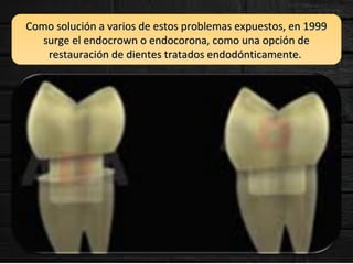 Endocrown_caso clinico | PPT
