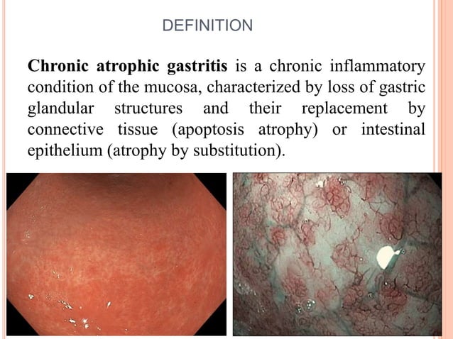 The role of non-invasive diagnosis in the evolution of chronic atrophic ...