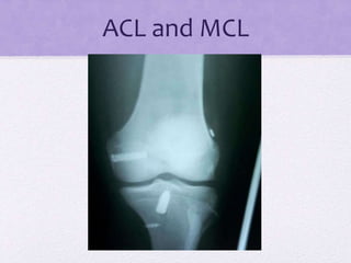 ARTHROSCOPY AND SPORTS MEDICINE I Dr.RAJAT JANGIR JAIPUR | PPTX