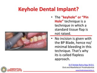 Key hole dental implants INDIA | PDF