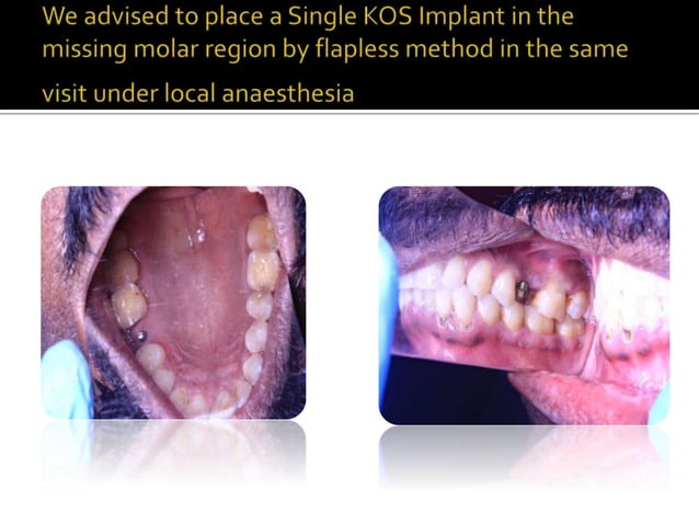 Keyhole implant placement in upper jaw | PPT