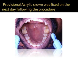 Keyhole implant placement in upper jaw | PPTX