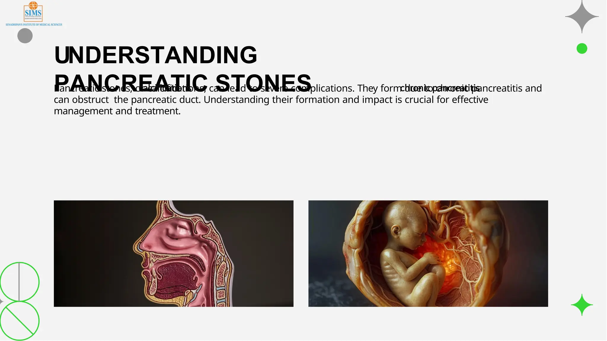Keyhole Surgery for Pancreatic Stone.pptx