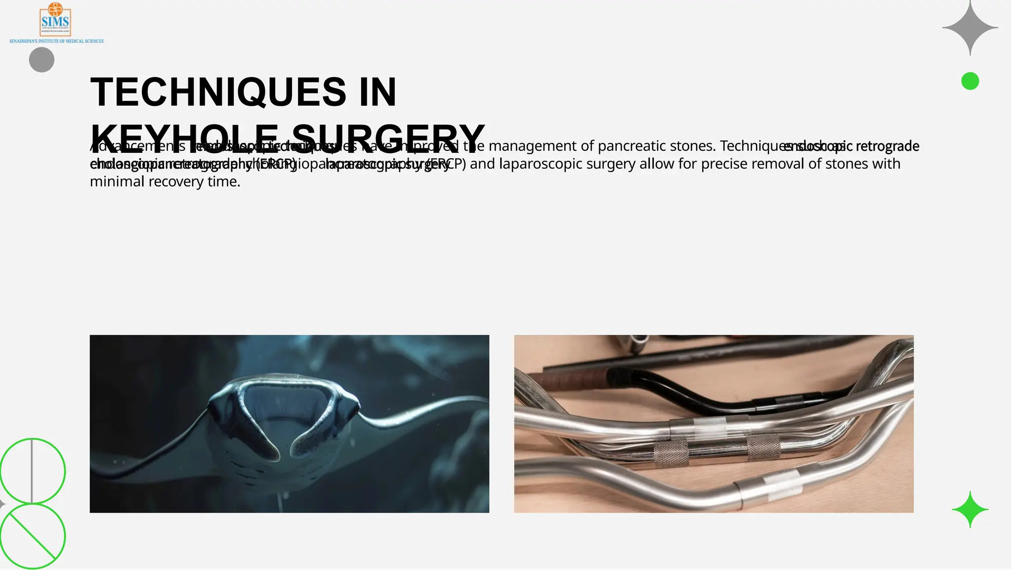 Keyhole Surgery for Pancreatic Stone.pptx