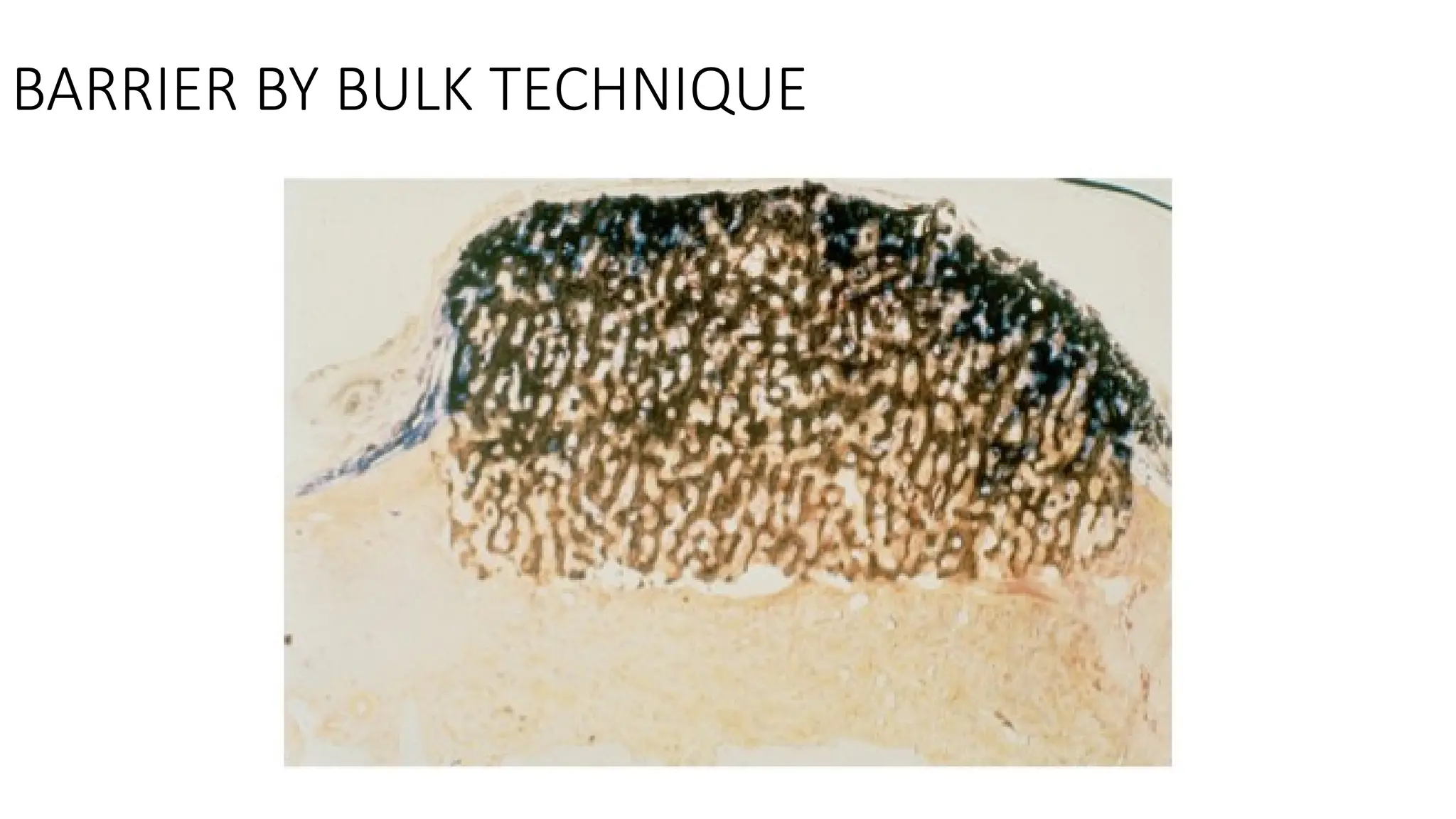 Keys to bone grafting and bone grafting Materials - Dr Smijal Gopalan ...