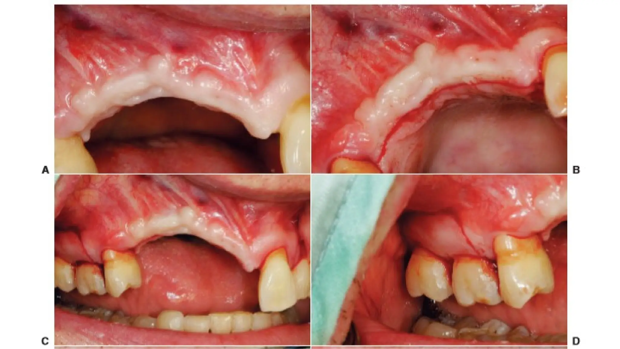 Keys to bone grafting and bone grafting Materials - Dr Smijal Gopalan ...