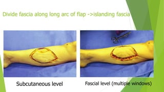 Keystone flaps | PPT