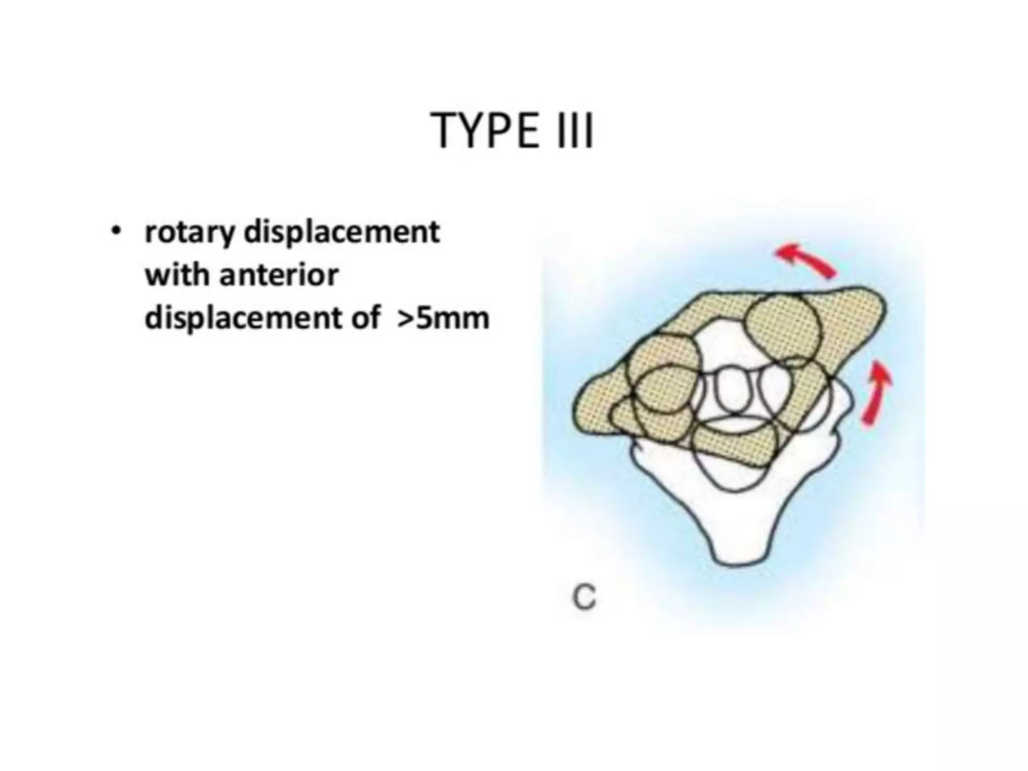Cervical Spine Fractures and injuries classification | PPT
