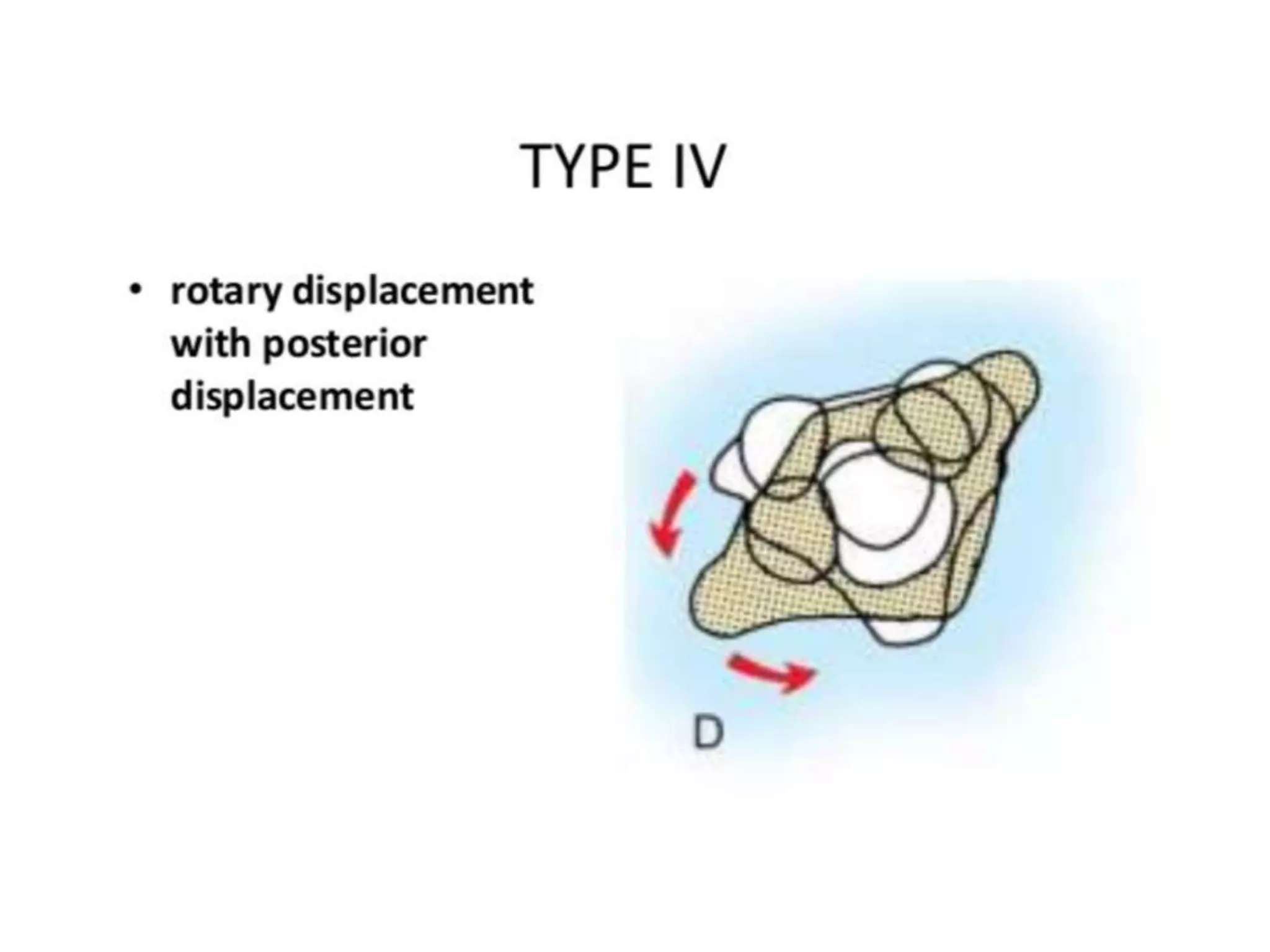 Cervical Spine Fractures and injuries classification | PPT