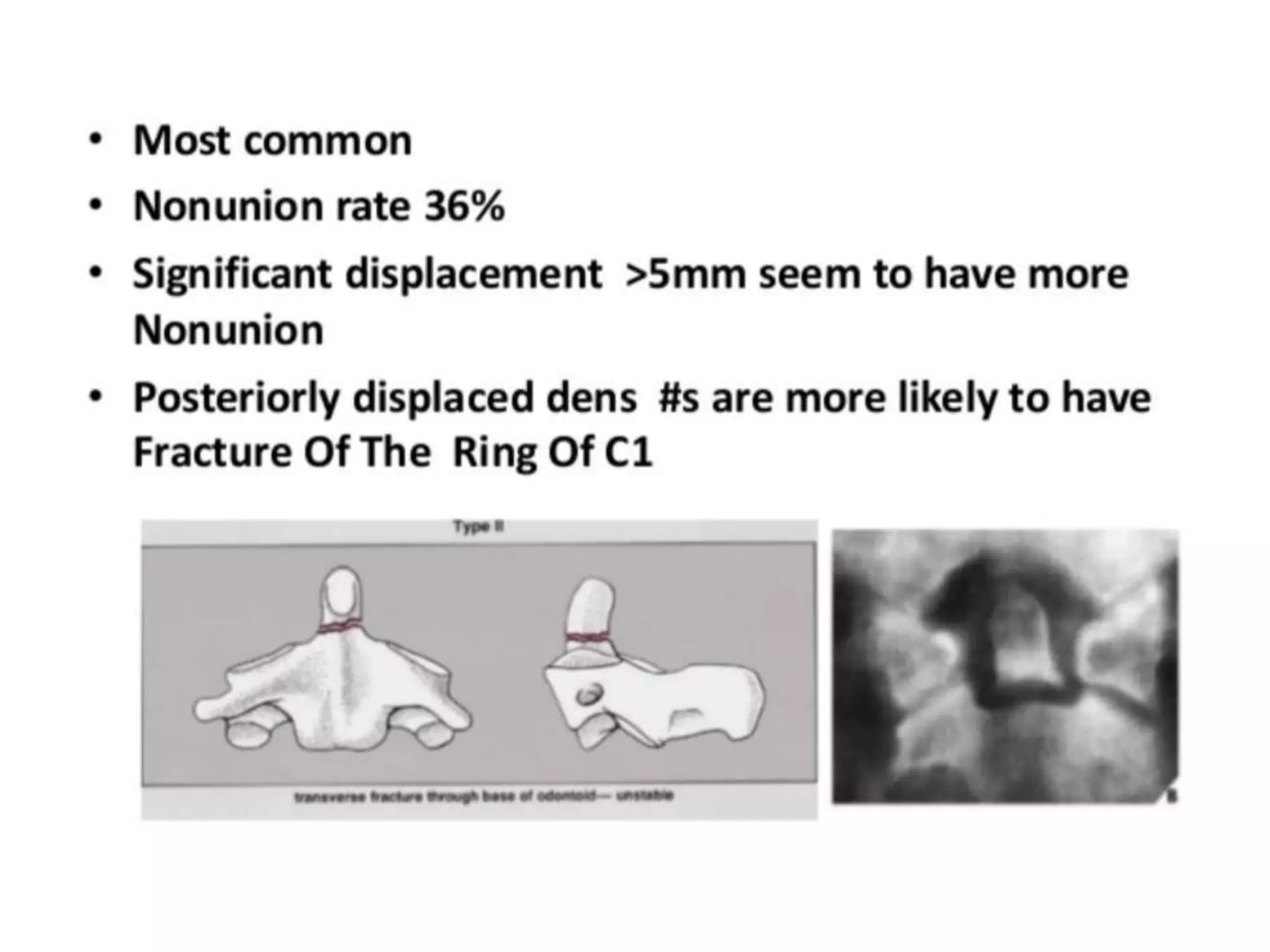Cervical Spine Fractures and injuries classification | PPTX