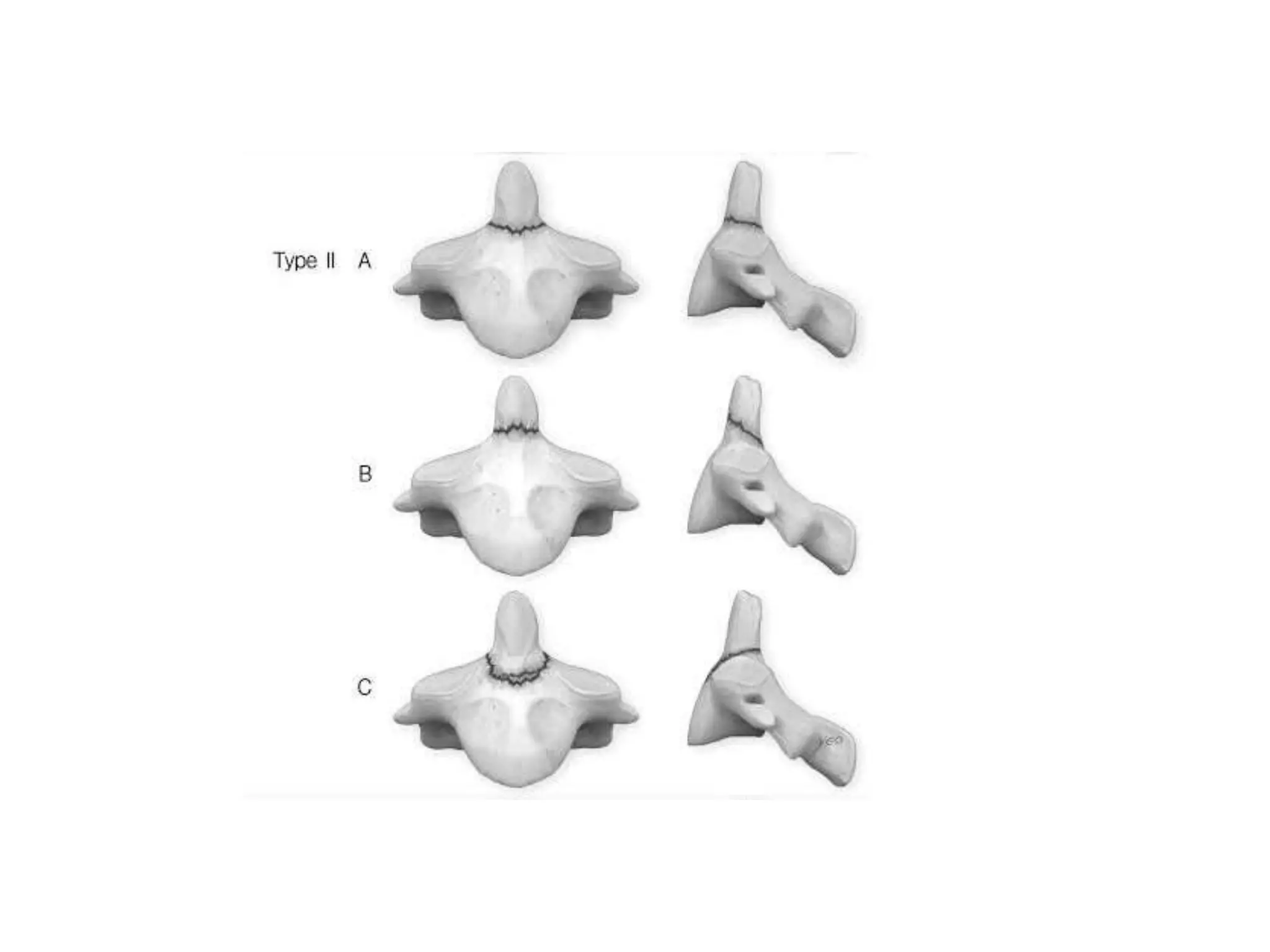 Cervical Spine Fractures and injuries classification | PPTX