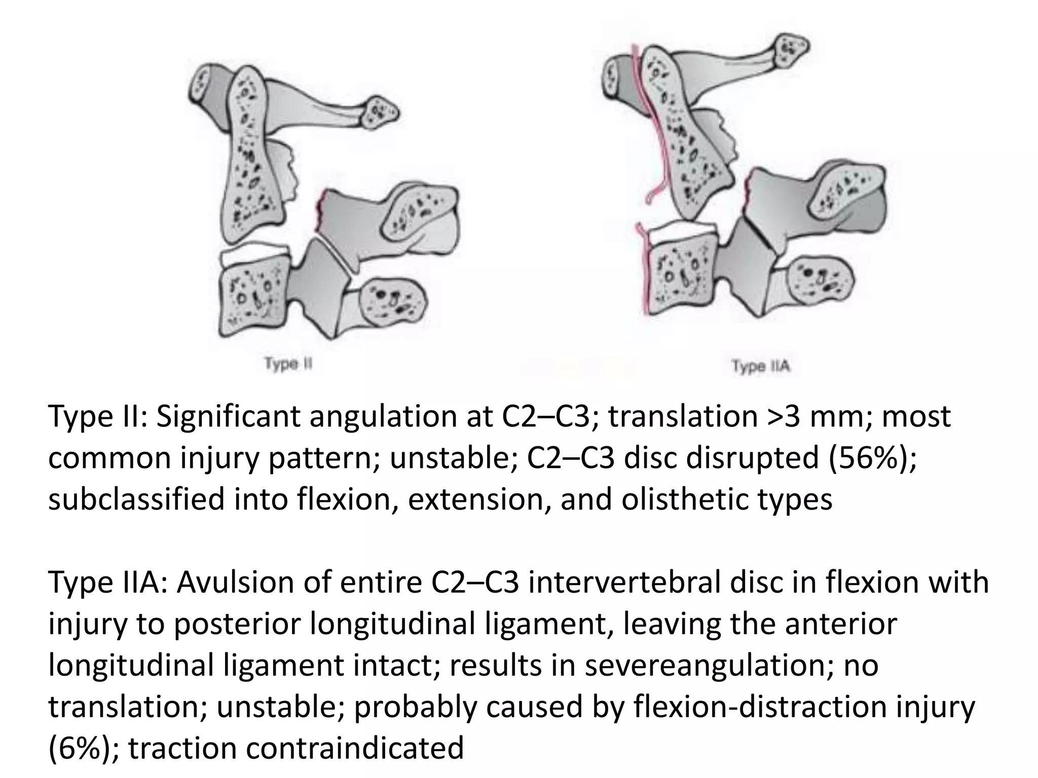 Cervical Spine Fractures and injuries classification | PPTX