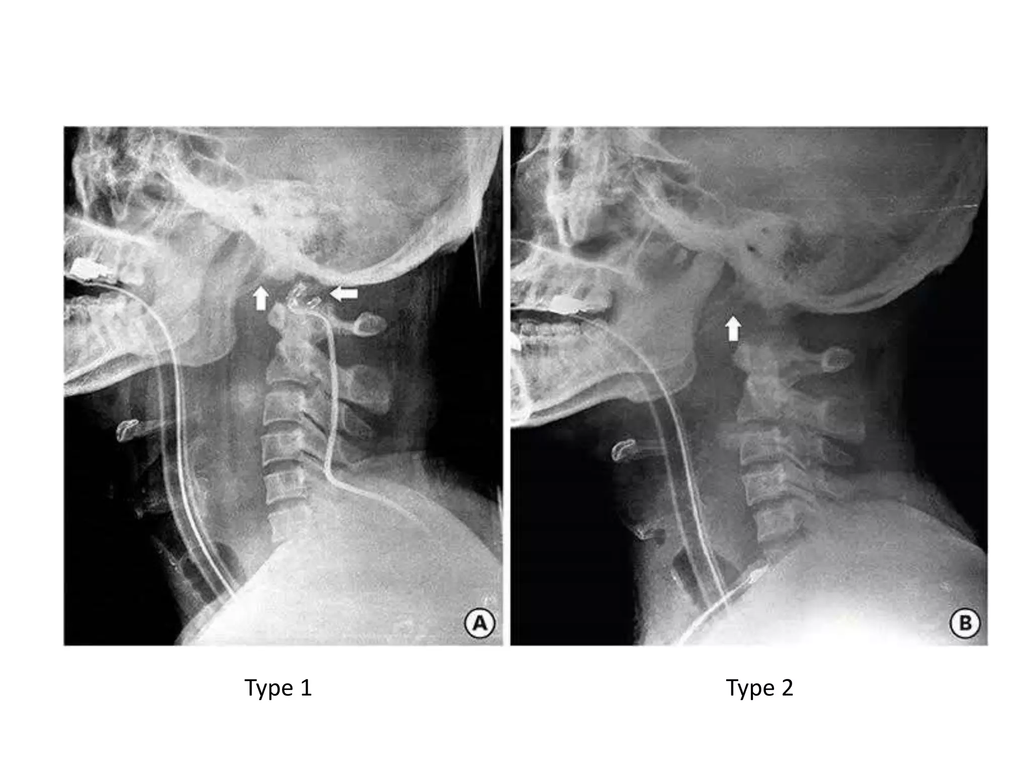 Cervical Spine Fractures and injuries classification | PPTX