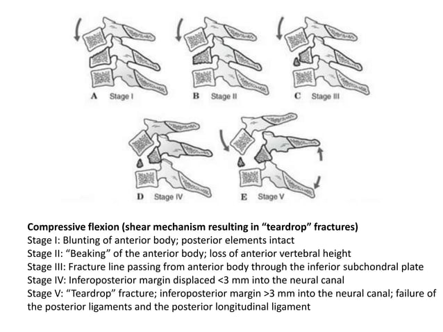 Cervical Spine Fractures and injuries classification | PPTX | Death ...