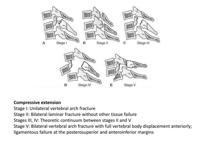 Cervical Spine Fractures and injuries classification | PPTX | Death, Injury, or Military ...