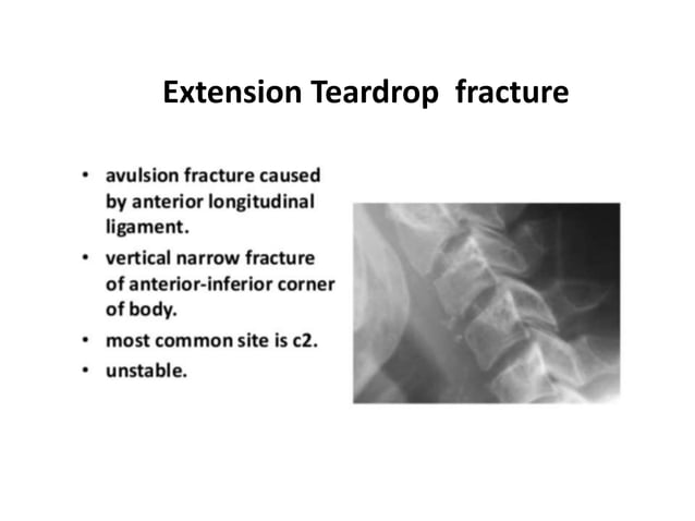 Cervical Spine Fractures and injuries classification | PPTX | Death ...