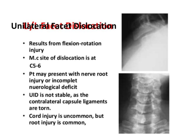 Cervical Spine Fractures and injuries classification | PPTX | Death ...