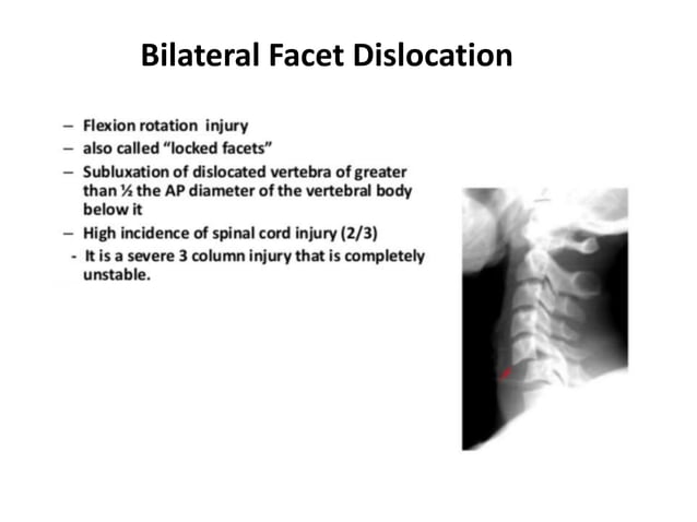Cervical Spine Fractures and injuries classification | PPTX | Death ...