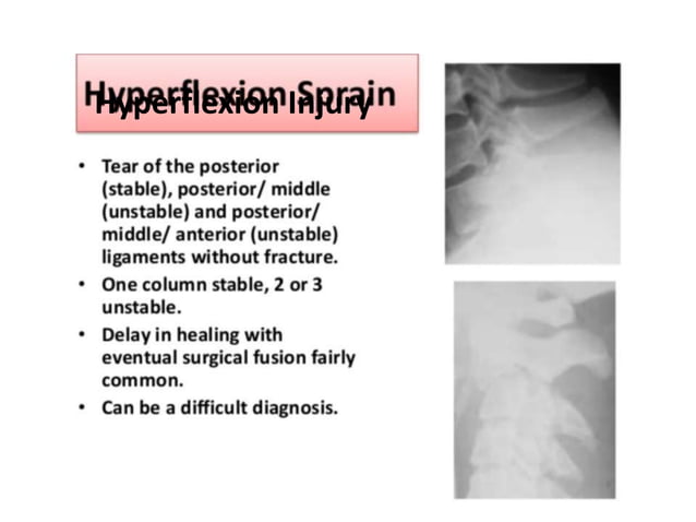 Cervical Spine Fractures and injuries classification | PPT
