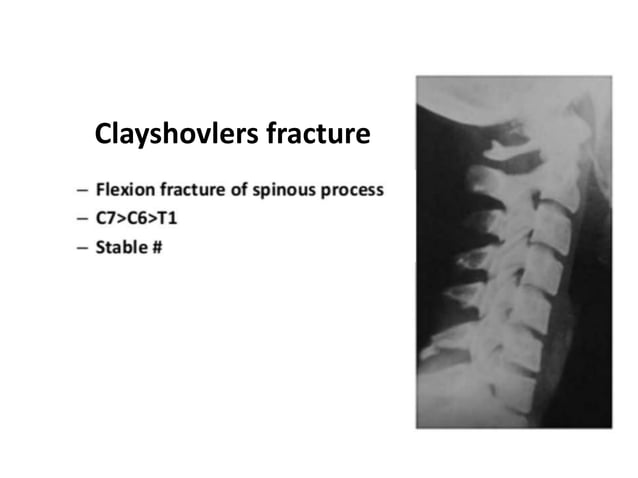 Cervical Spine Fractures and injuries classification | PPTX | Death ...