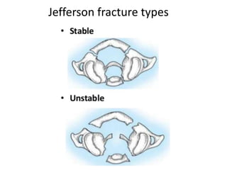 Jefferson Fracture Classification