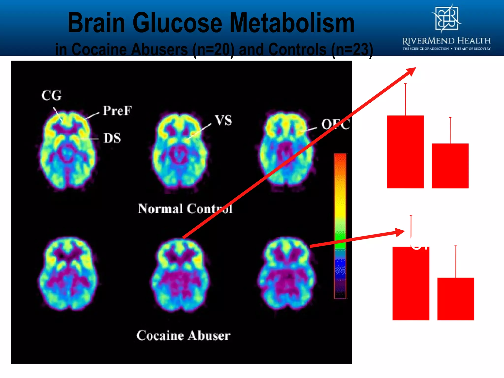 Addiction as a brain disease Brain Imaging in Addictions | PPT
