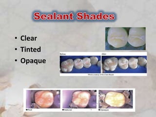 Preventive Dentistry (pit & fissure sealants) | PPTX