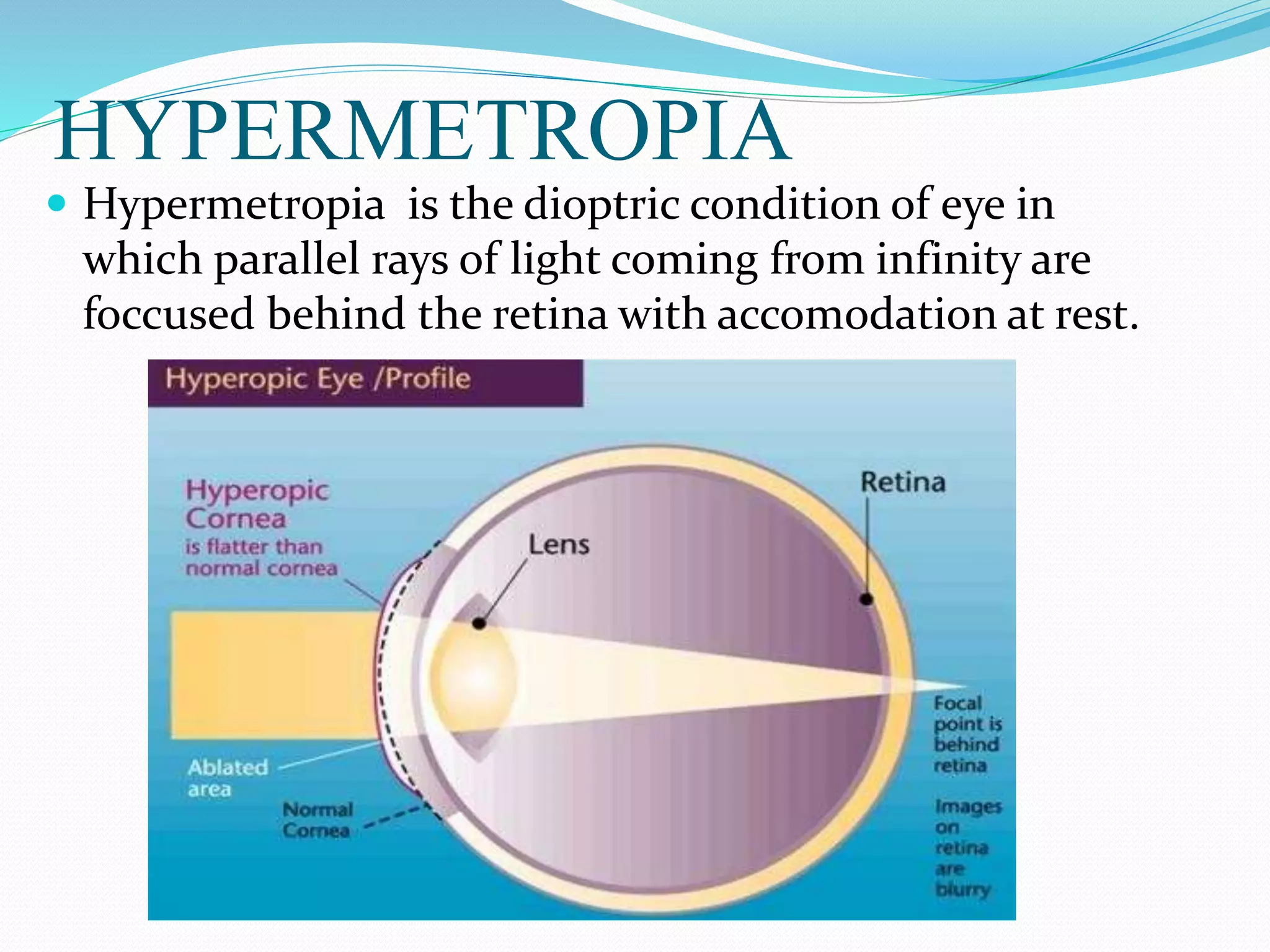 Hypermetropia also known as Hyperopia or Farsightedness is a common ...