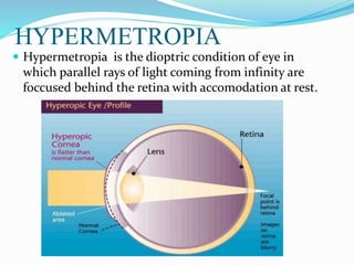 Hypermetropia also known as Hyperopia or Farsightedness is a common ...