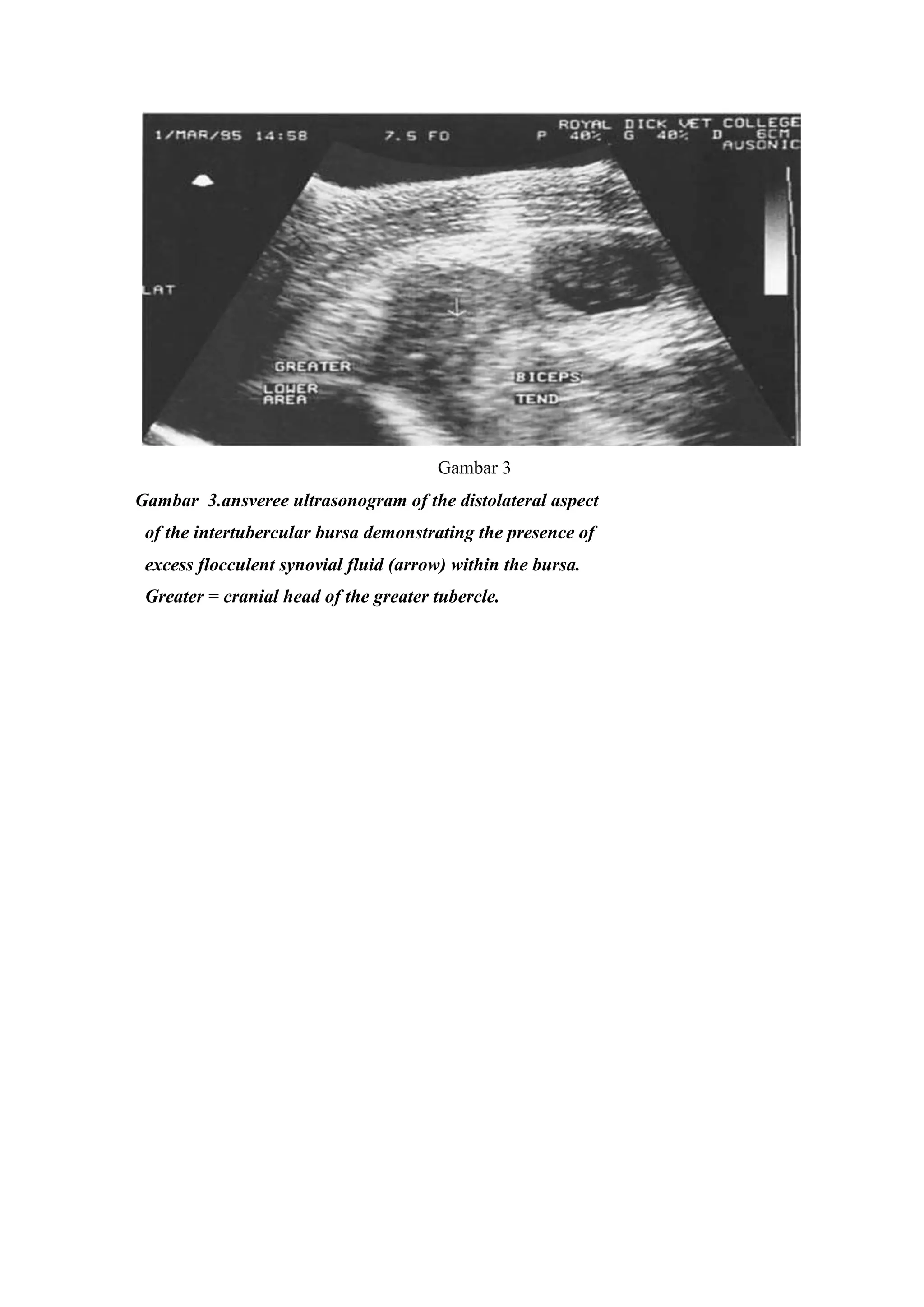 Sweeney Disease, Bursitis Infraspinatus,Bursitis Intertubercularis dan ...