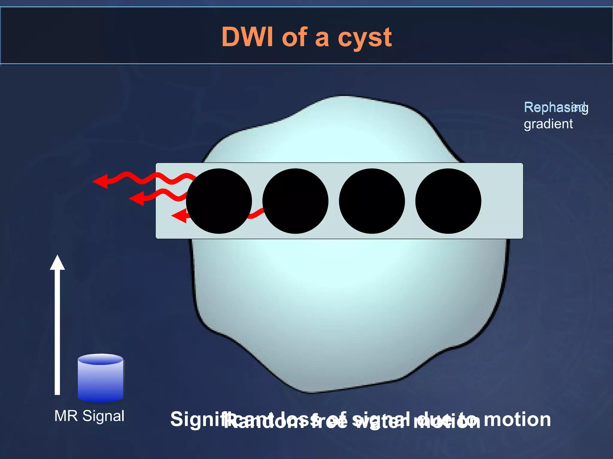 Khatri dwi cyst | PPT