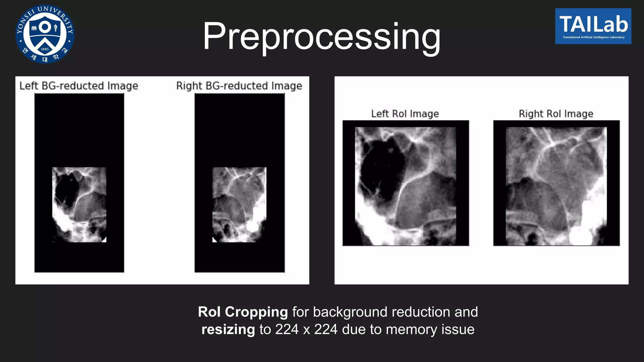 Diagnosis of Maxillary Sinusitis in Water’s view based on Deep learning ...