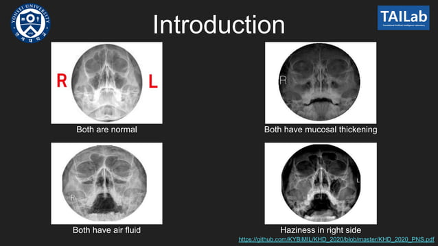 Diagnosis of Maxillary Sinusitis in Water’s view based on Deep learning ...