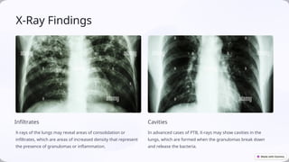 Infiltrative pulmonary tuberculosis in human | PPTX
