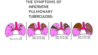 Infiltrative pulmonary tuberculosis in human | PPTX