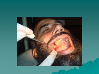 Khitab's Classification of post extraction pain | PPTX