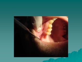 Khitab's Classification of post extraction pain | PPTX