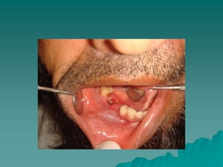 Khitab's Classification of post extraction pain | PPTX