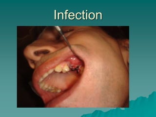 Khitab's Classification of post extraction pain | PPTX